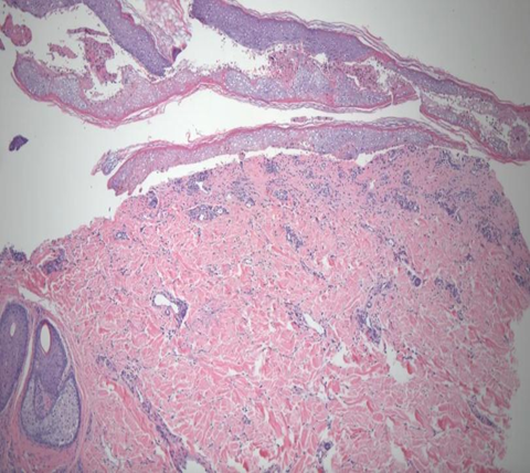 Bullous Pemphigoid Outbreak Following Administration of Multiple ...