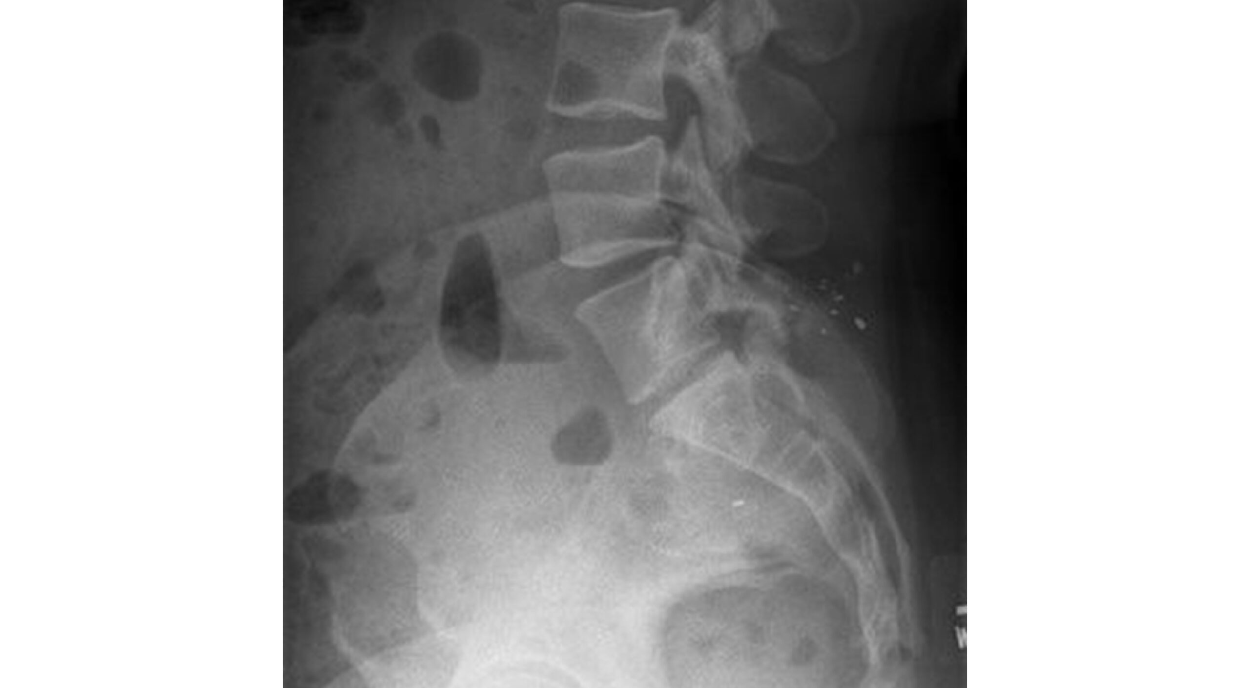 Retained Lead Bullet Fragments in Woman of Childbearing Age - medtigo ...