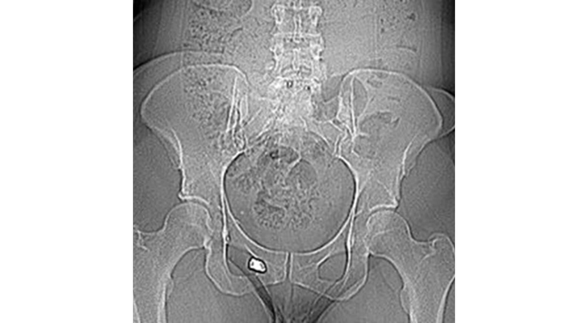 Retained Lead Bullet Fragments in Woman of Childbearing Age - medtigo ...