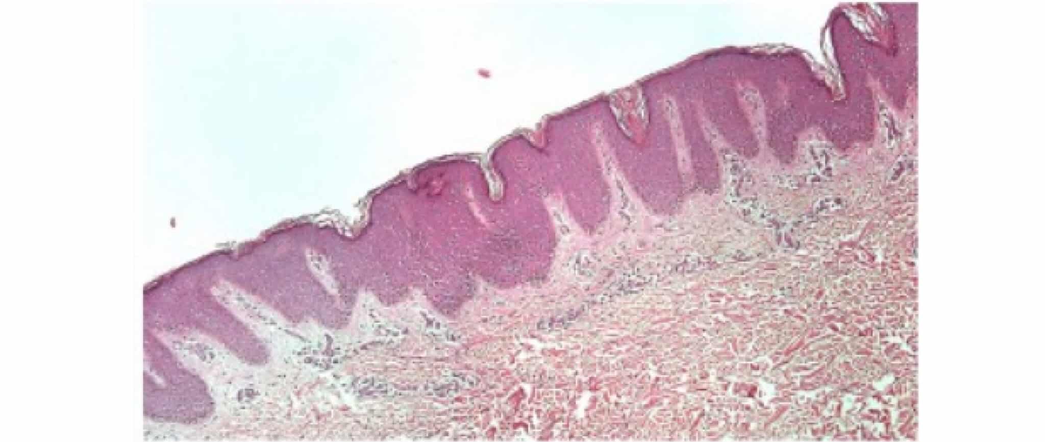 Irregular Brown Lesions With Poorly Defined Borders in an Asymptomatic ...