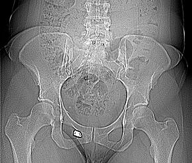 Retained Lead Bullet Fragments in Woman of Childbearing Age - medtigo ...